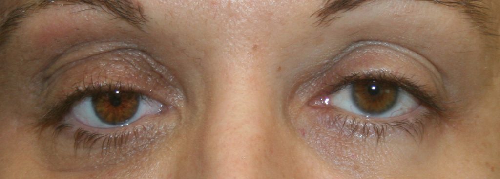 Prosthetic Examples - EYEART Laboratories